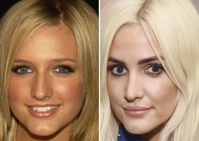 Discover The Best Celebrity Rhinoplasty Nose Jobs | Cosmetic Town