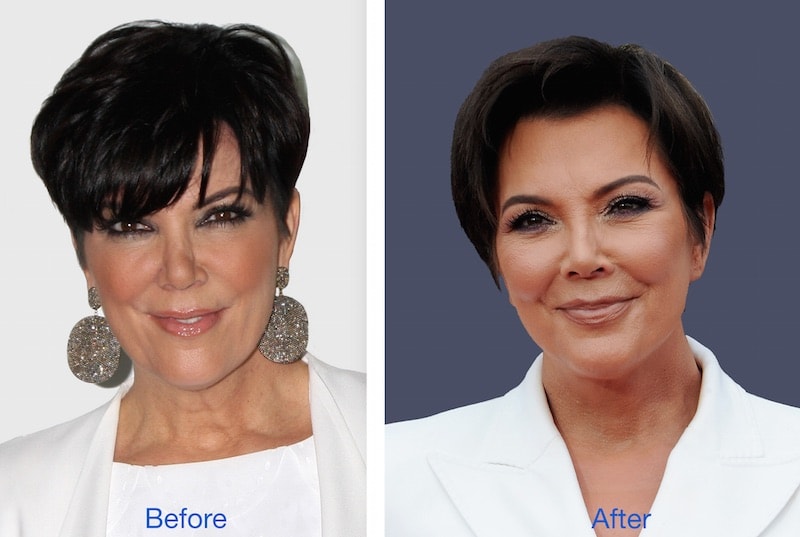 Discover the many Plastic Surgery Secrets of Kris Jenner | Cosmetic Town